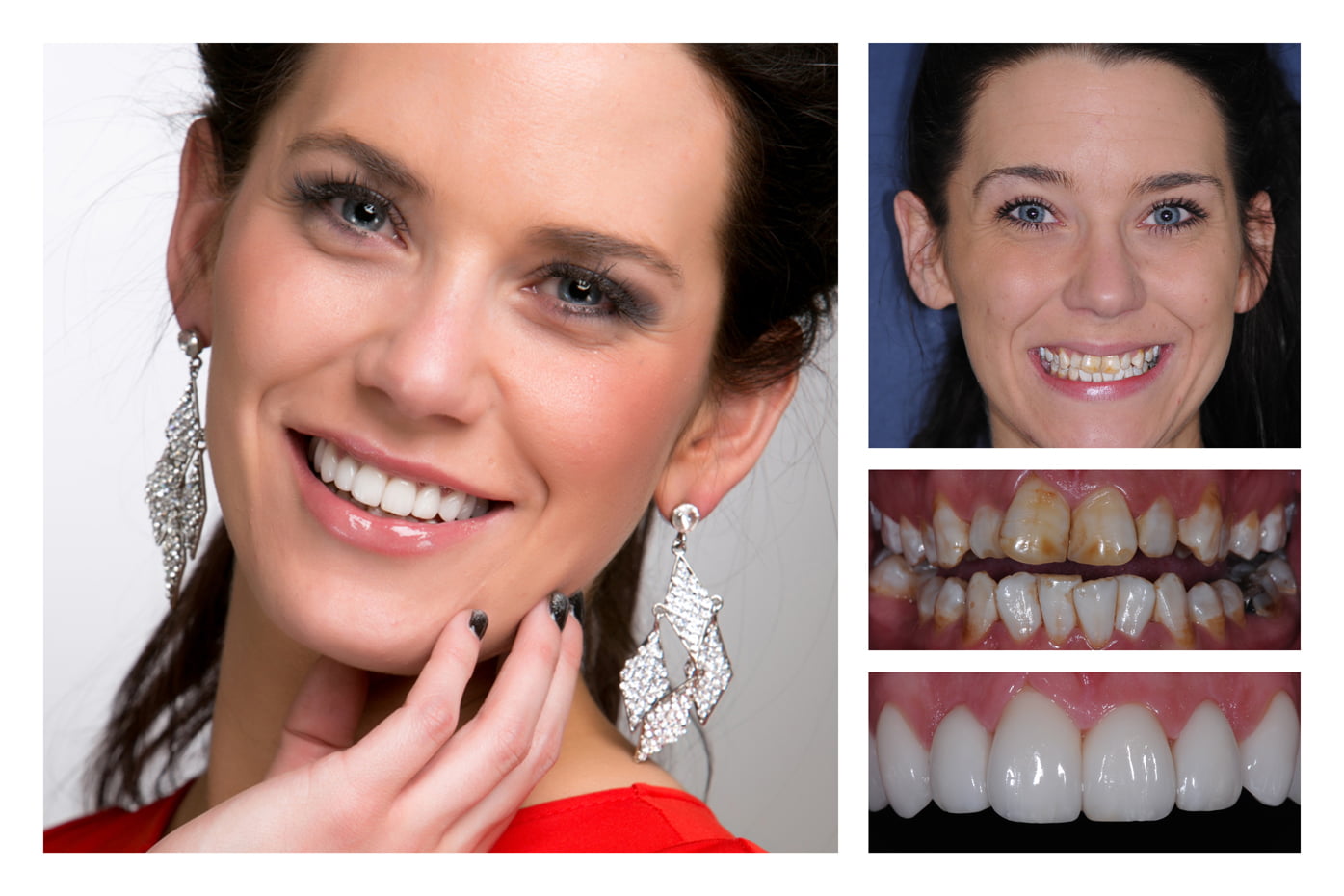 Smile Makeover Guide: All You Need to Know About Composite Veneers ...
