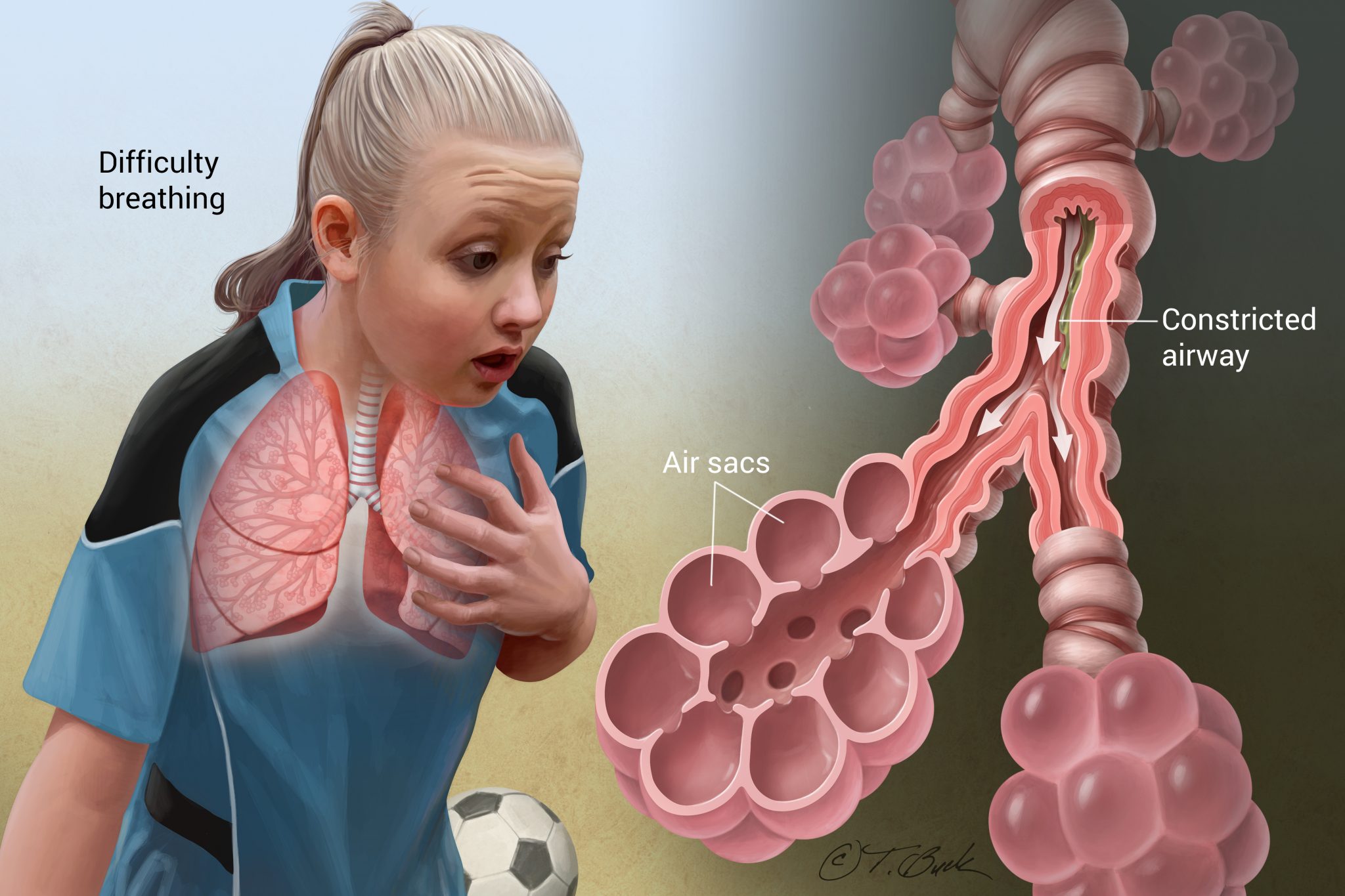 Thirty 3 Percent Of New Adolescence Allergies Cases Fit Netion