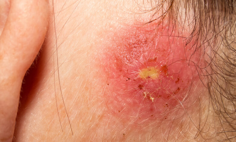 Staph Skin Infection Treatments - Is There A Cure For Staph? - Health Cise