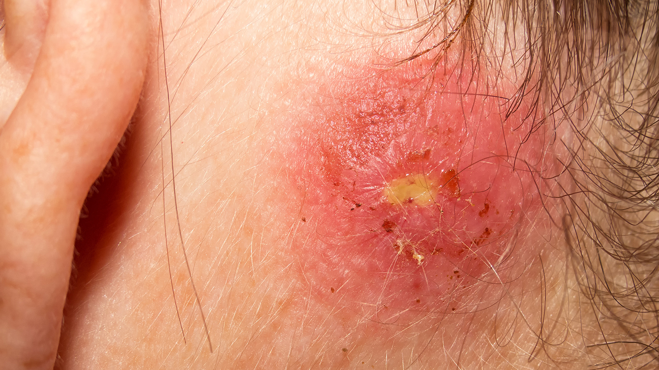 Staph Skin Infection Treatments - Is There A Cure For Staph? - Health Cise
