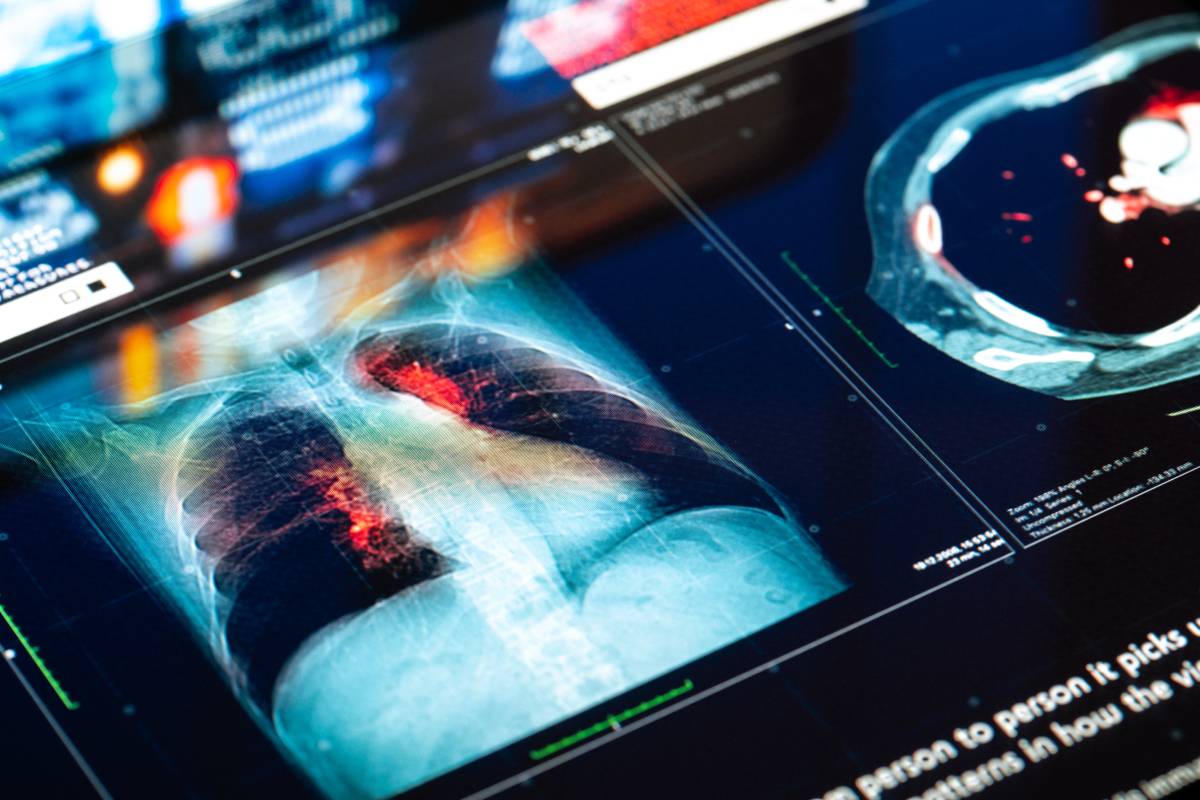 Understanding Multifocal Pneumonia: Multiple Lung Infections - Health Cise