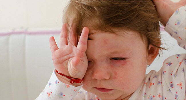 Roseola: Facts and Symptoms - Health Lar