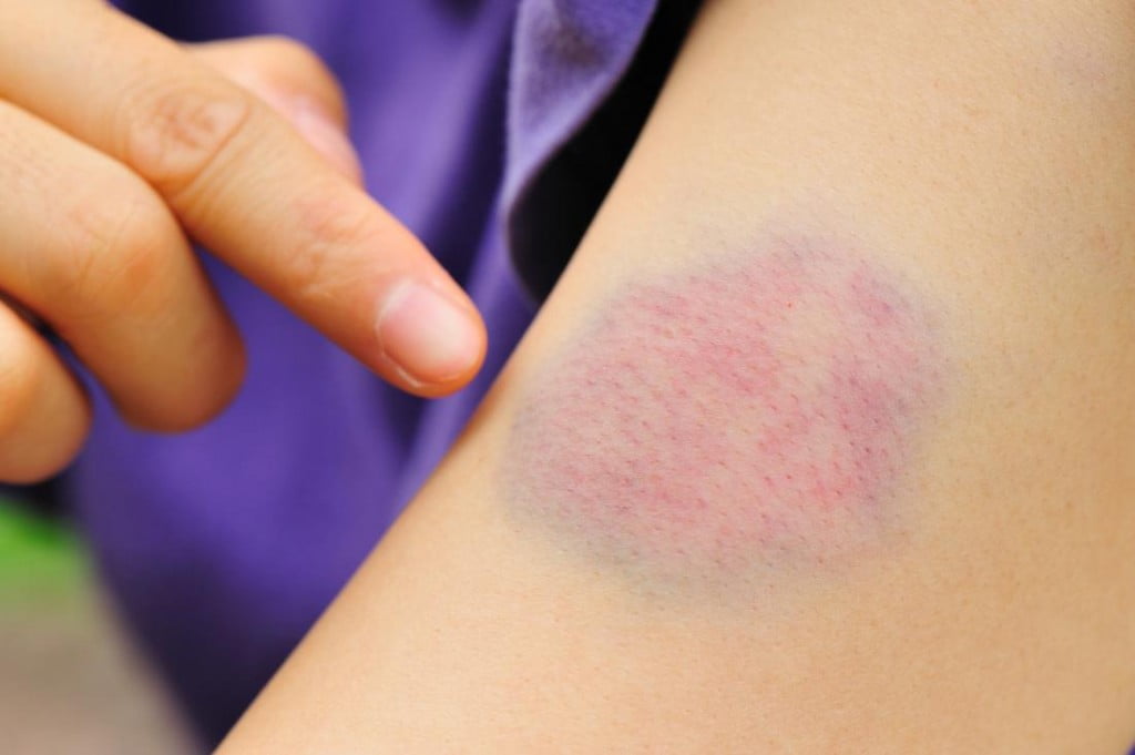 Home treatments to treat and relieve bruises - Health Sone