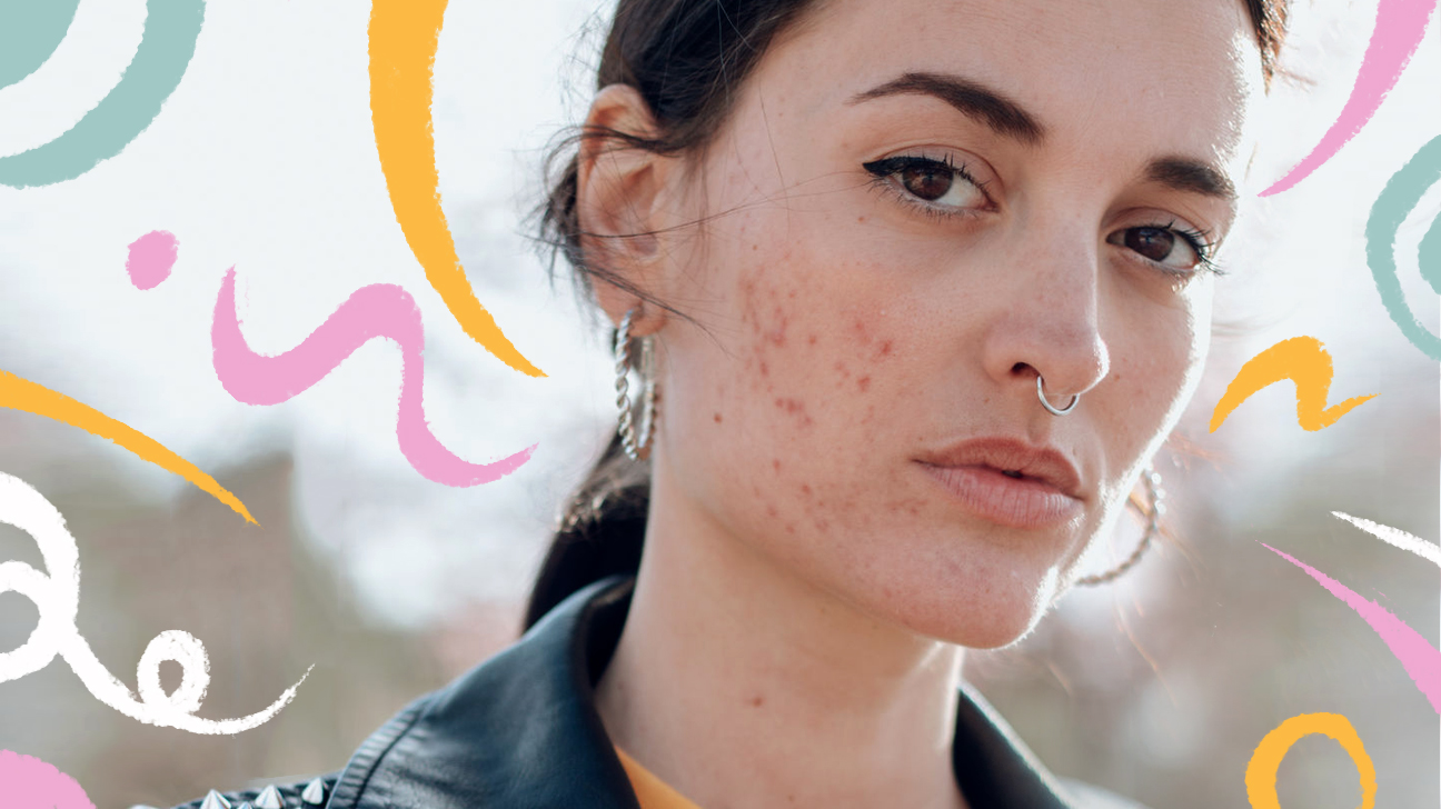 Relaxed Skin - How to Get Rid of Your Acne?