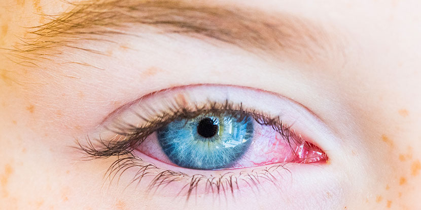 Find Out the Real Causes of Pink Eye and How to Prevent It