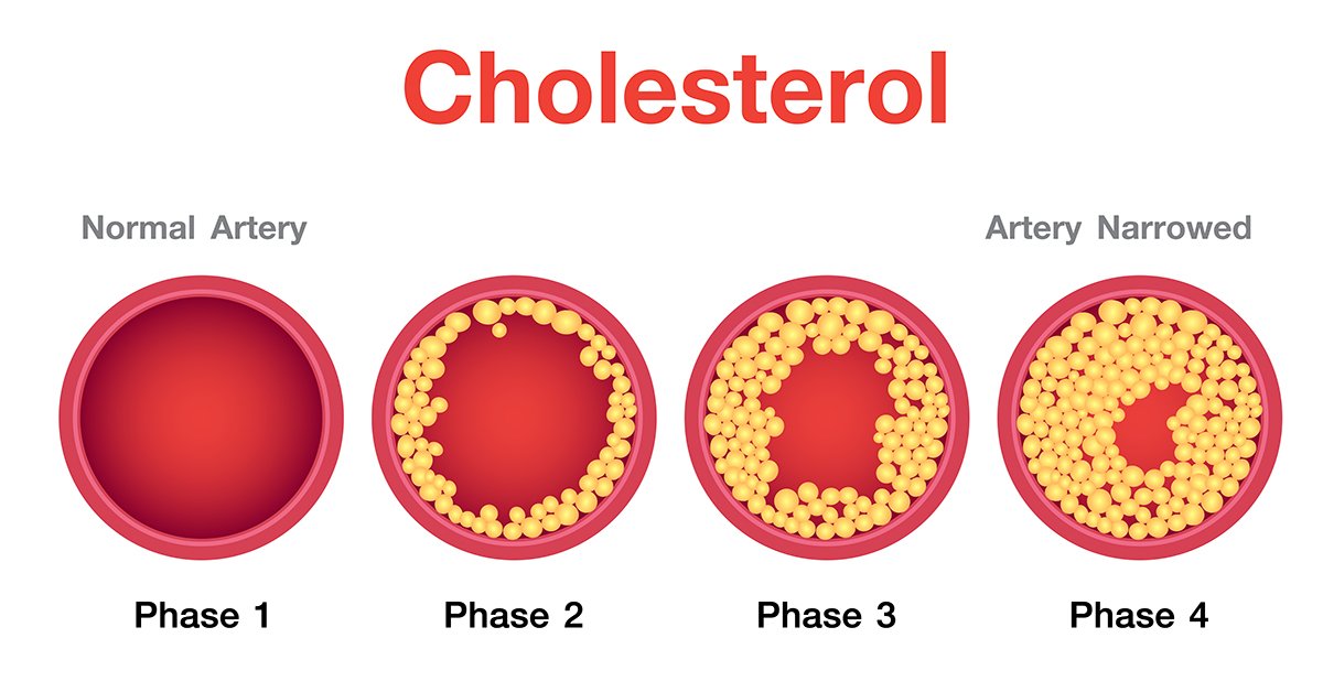 Non-invasive scanning tech reads blood levels of cholesterol thru the ...
