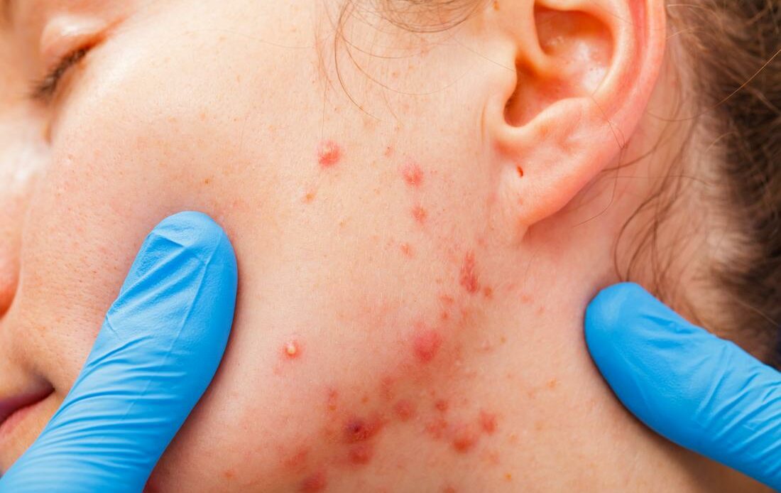 How to remove blood pimples fast at home