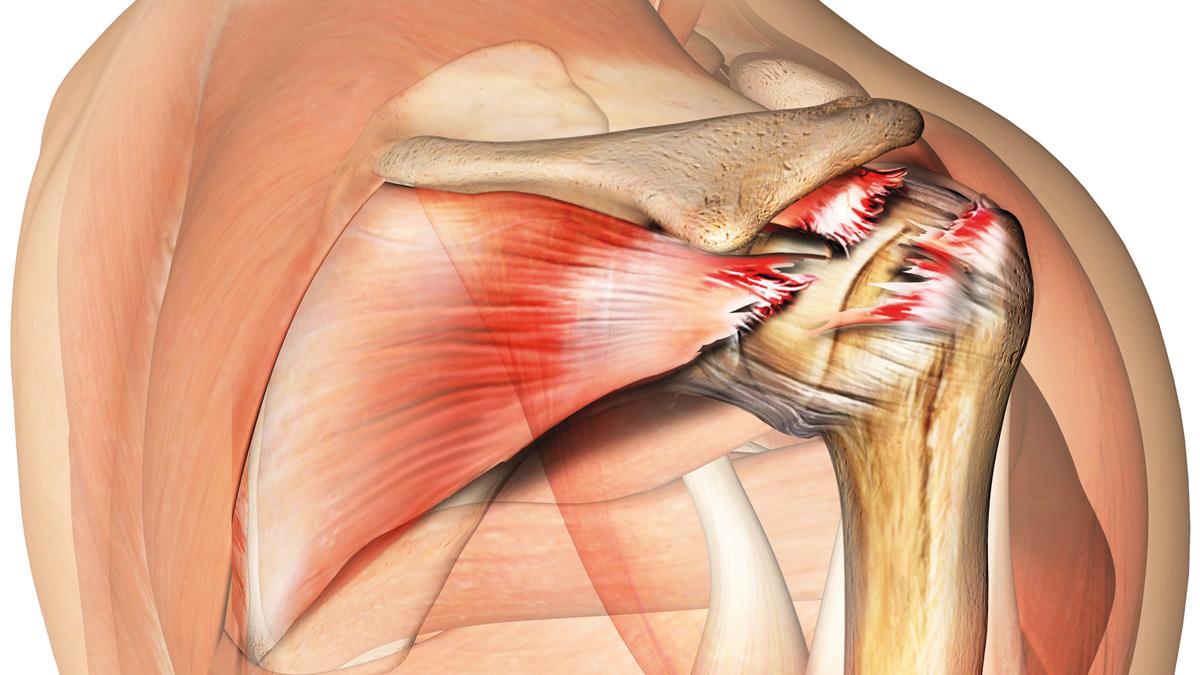 Rotator Cuff Injury Exercise Video